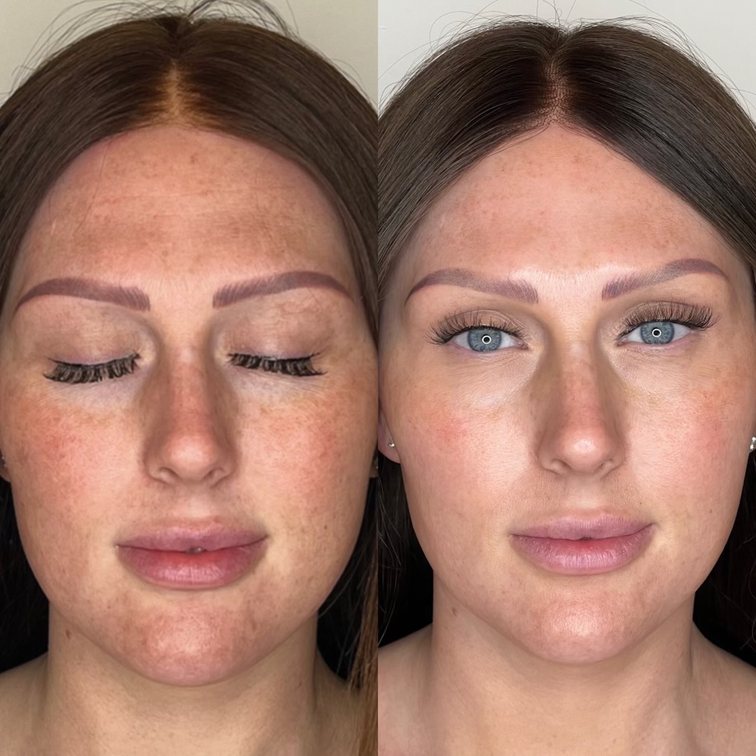 BBL/IPL - Amor Med Spa and Aesthetics